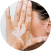 Treatment For Vitiligo || Treatment For White Patches on Skin