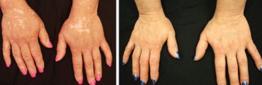 Treatment For Vitiligo || Treatment For White Patches on Skin